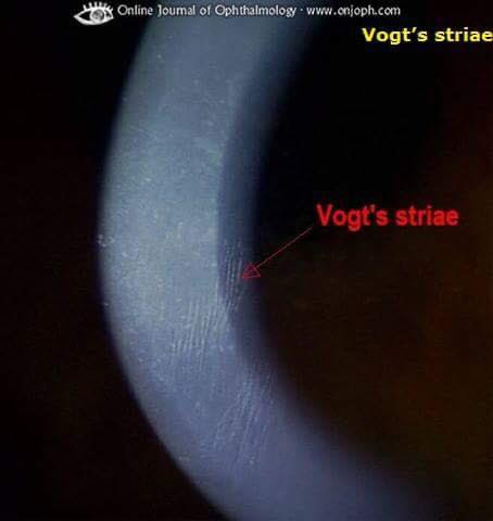 Ophthalmology Notes: Lines in Ophthalmology