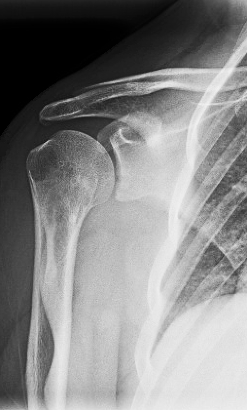 Shoulder Arthritis / Rotator Cuff Tears / Shoulder Pain ...