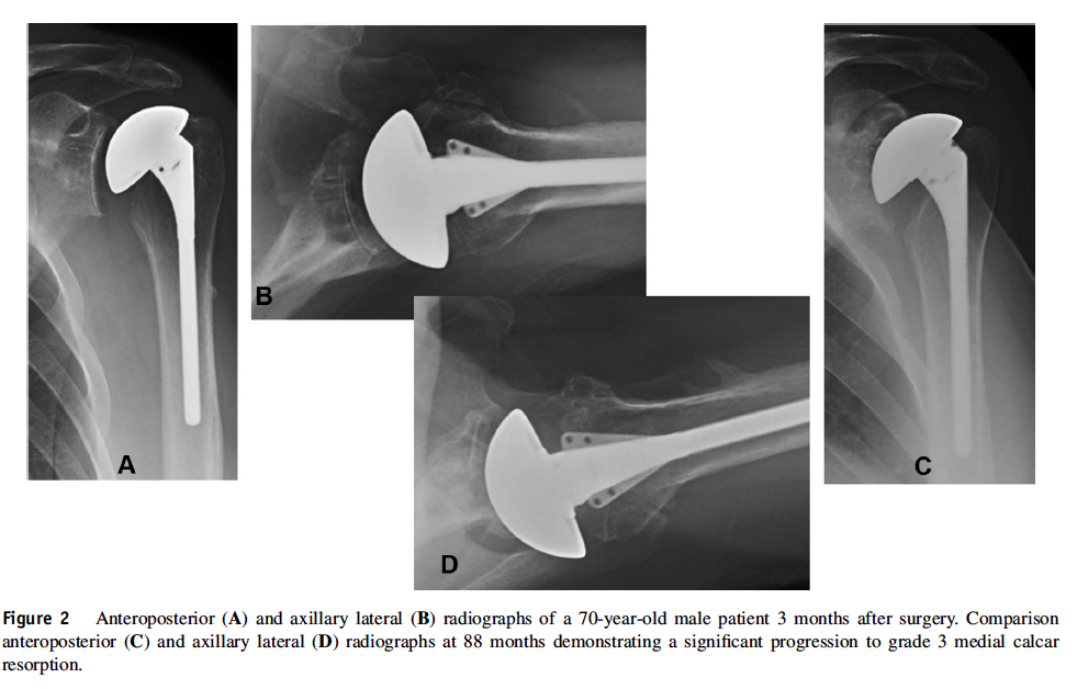 UW Shoulder and Elbow Academy: Total shoulder arthroplasty - medial ...
