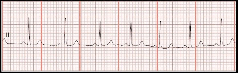 Practice EKG Rhythm Strips 111