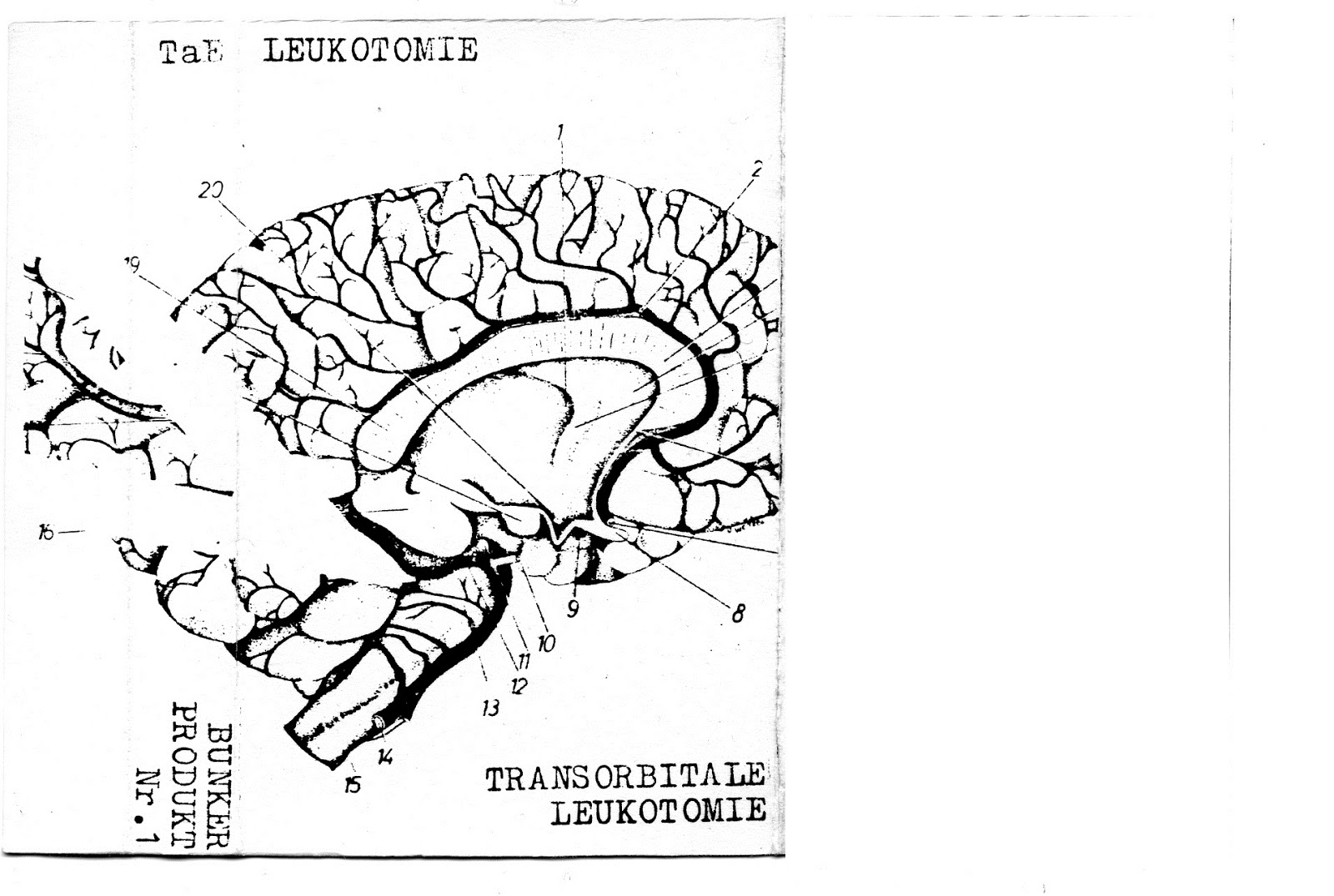 Crossing all Borders: TaE - Leukotomie / Transorbitale Leukotomie