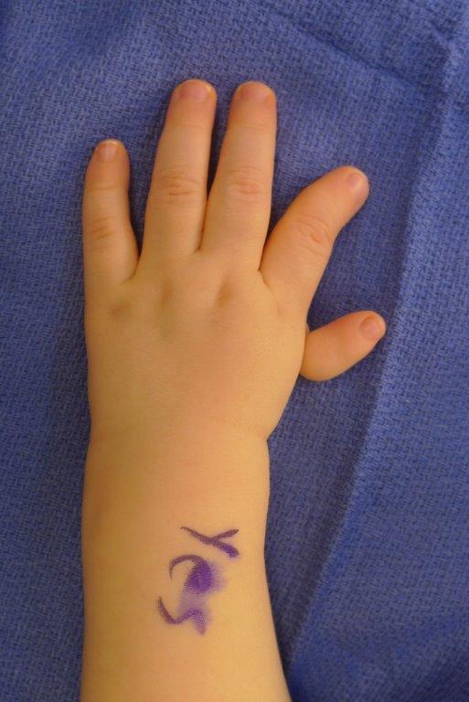 Pollicization Long Term | Congenital Hand and Arm Differences ...