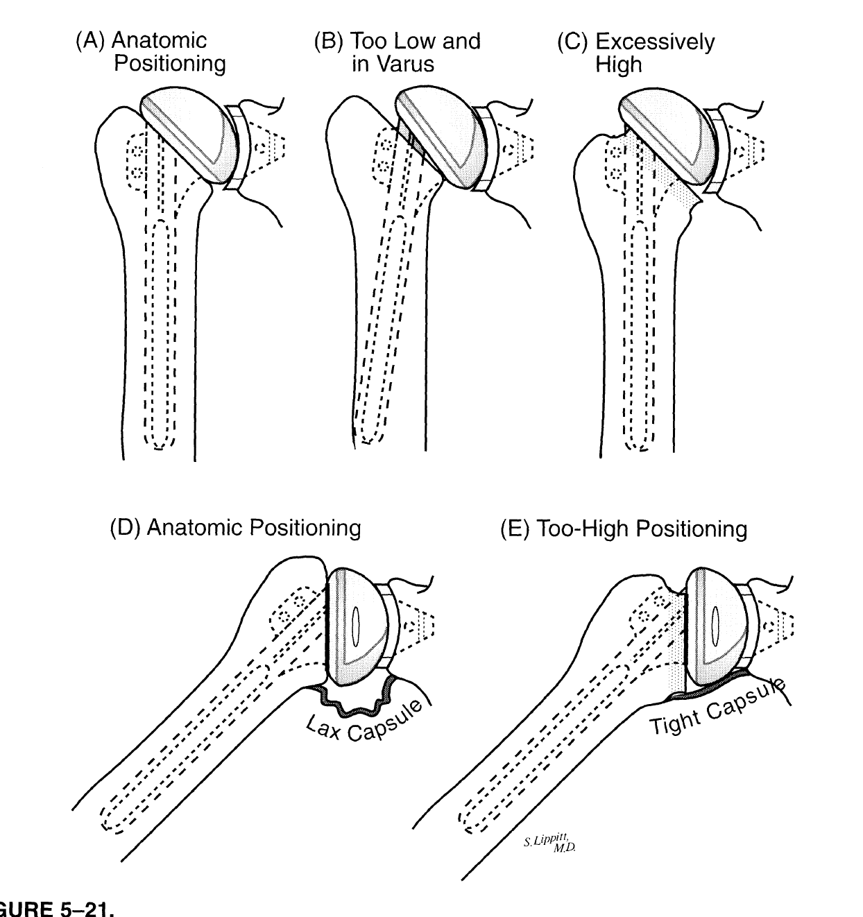 UW Shoulder and Elbow Academy: Overstuffing and the importance of ...