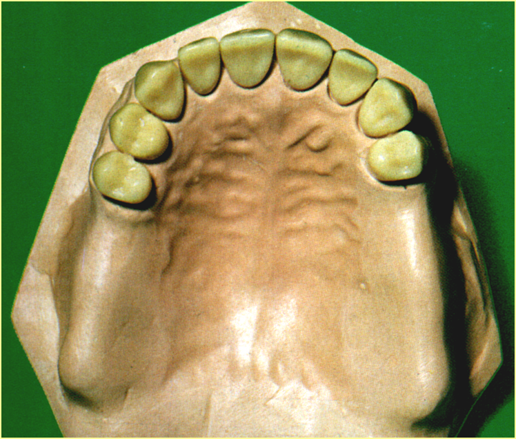 Clasificación de kennedy
