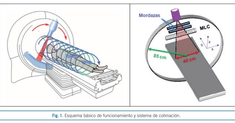 TOMOTERAPIA HELICOIDAL