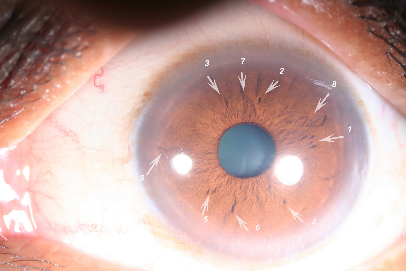 Modern & Multidimensional Iridology: Analysis of Lacuna & Crypt