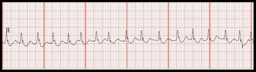 Practice EKG Rhythm Strips 97