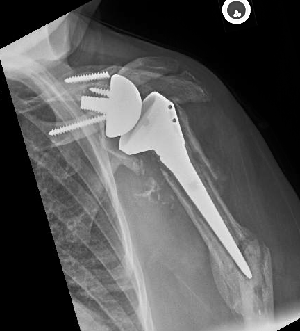 UW Shoulder and Elbow Academy: Reverse total shoulders - failures in ...