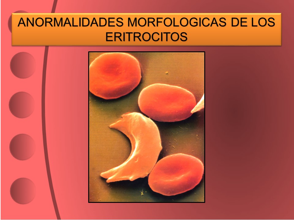HEMATOLOGIA 2016 (FICHERO): ANORMALIDADES DE LOS ERITROCITOS