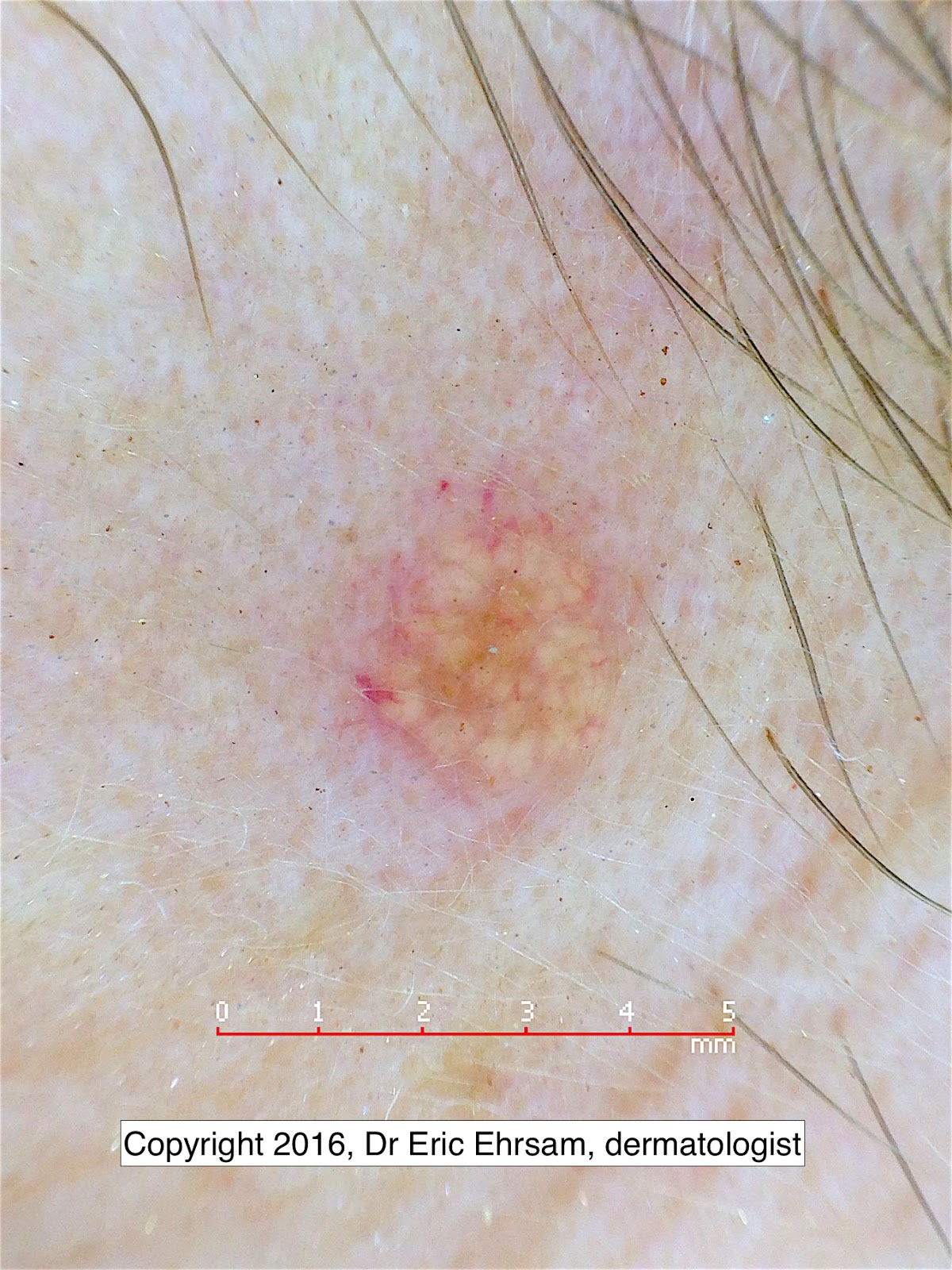 dermoscopy: A yellowish lesion