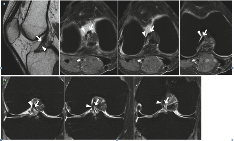 MRI Dây Chằng Chéo Trước (ACL)