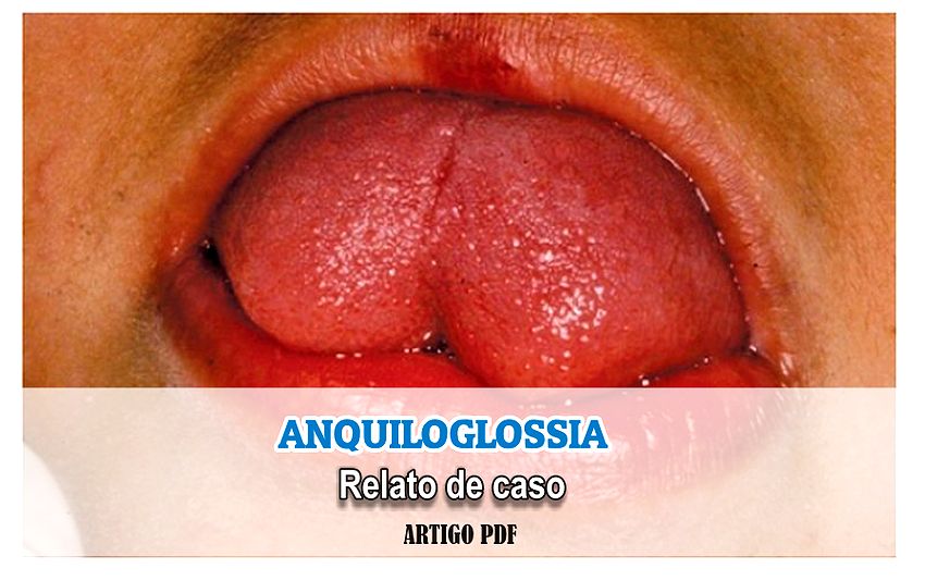PDF: Anquiloglossia: relato de caso