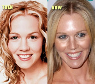 Jennie Garth Plastic Surgery