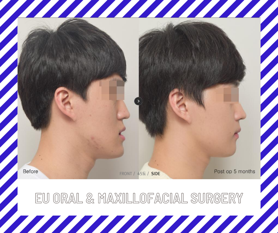 What happens when you have an Underbite?_EU