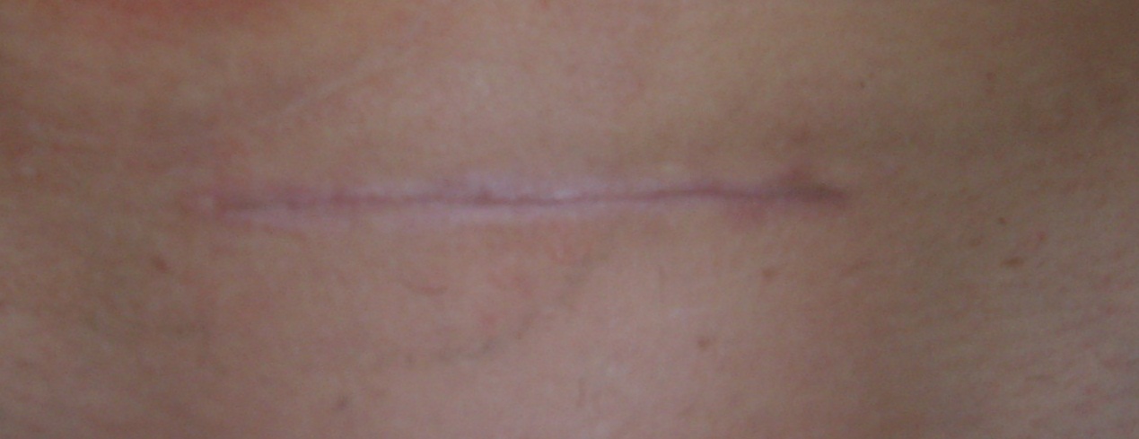 Fighting For It.: Healing Incisions