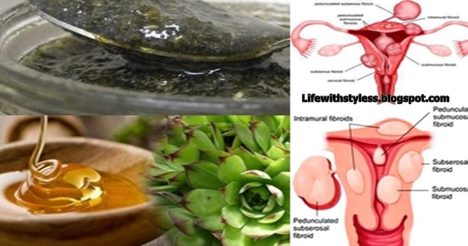 5 Home Remedies To Get Rid Of Cysts And Fibroids Naturally Life With