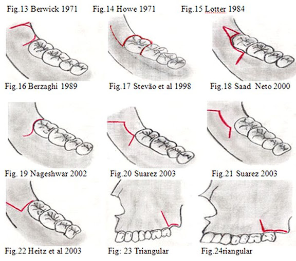 COLGAJO en CIRUGÍA BUCAL: Incisiones para exodoncia de Terceras Molares ...