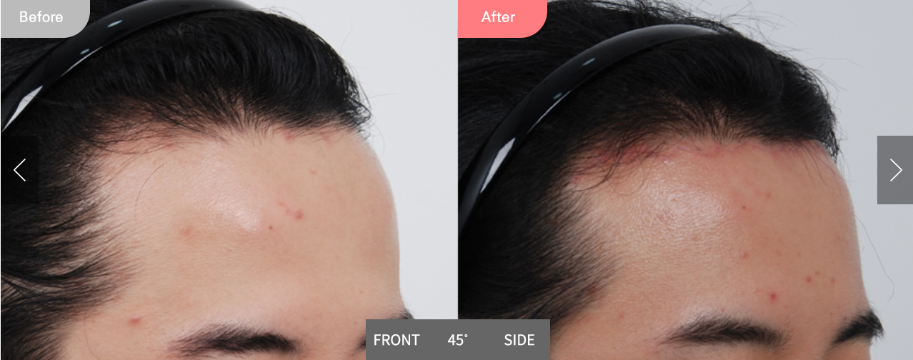 [ATOP Plastic Surgery Korea] Forehead Reduction (Forehead shortening ...