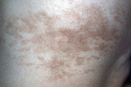 EL RINCÓN DE LA MEDICINA INTERNA. juanpedromacaluso@yahoo.com.ar: NEVUS ...