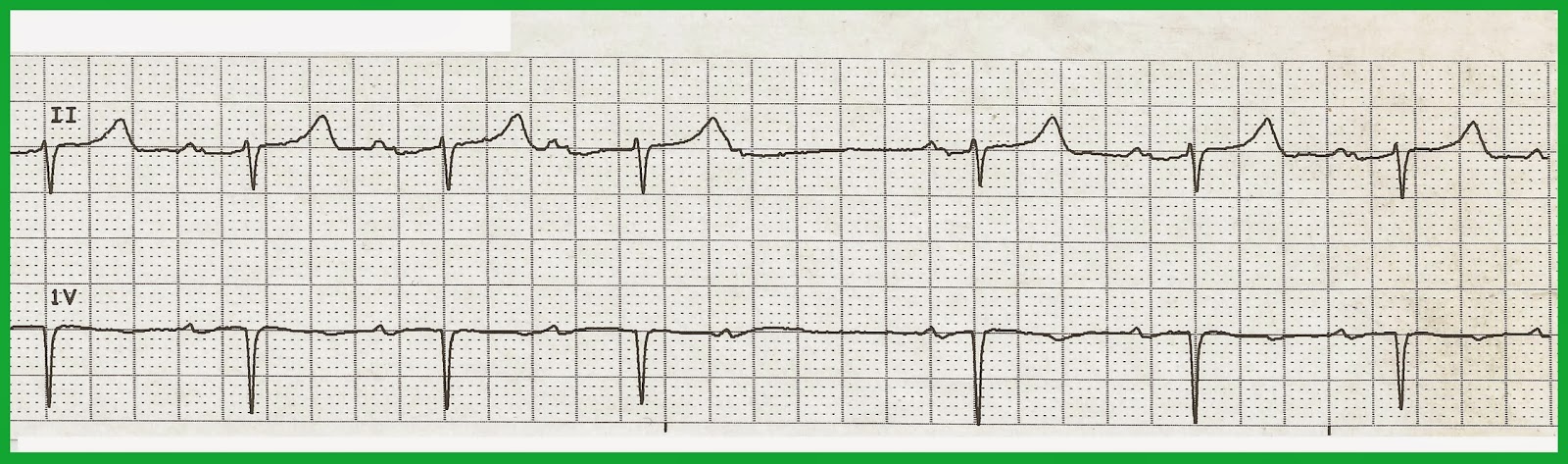 Practice EKG Rhythm Strips 215