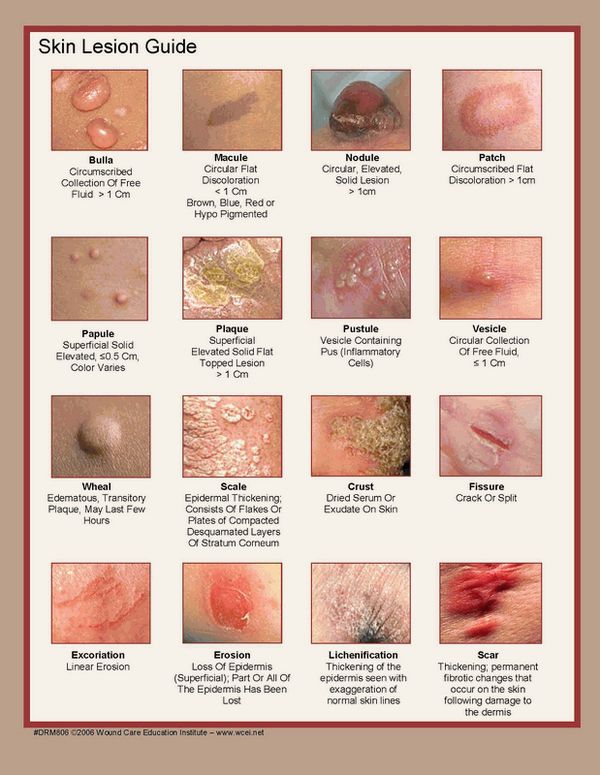 Share Everything: Gambaran Jenis Kelainan Pada Kulit (Skin Lesion Guide)