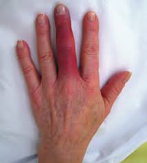 El Síndrome de Achenbach ~ El Médico Contesta