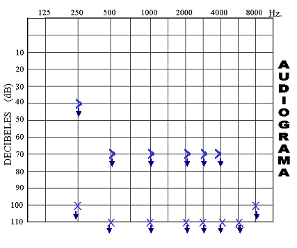 Audiometría: Diagnóstico Audiológico ~ Audiología didáctica para ...