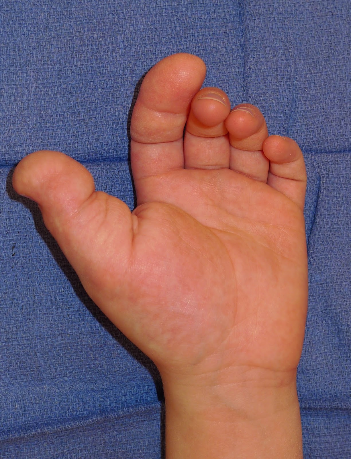 Macrodactyly/ Large digits | Congenital Hand and Arm Differences ...