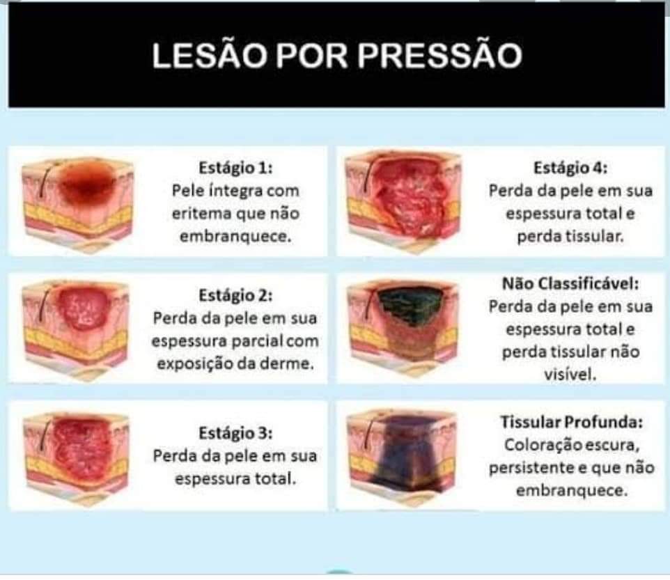 Escara ou lesão por pressão? Escara é o tecido humano necrosado, morto ...