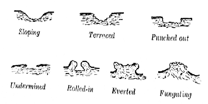 Ulcers | Examination, Defferential Diagnosis and how to diagnose