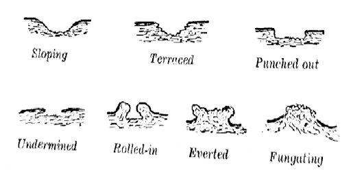 Ulcers | Examination, Defferential Diagnosis and how to diagnose