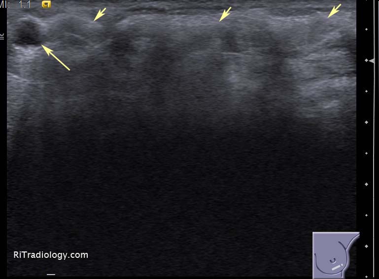 RiT radiology: Silicone Granulomas