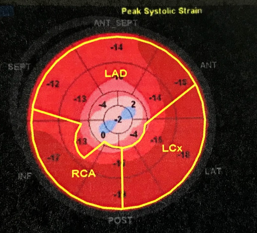 Pedi cardiology: Strain rate imaging - Peak systolic strain - Polar map