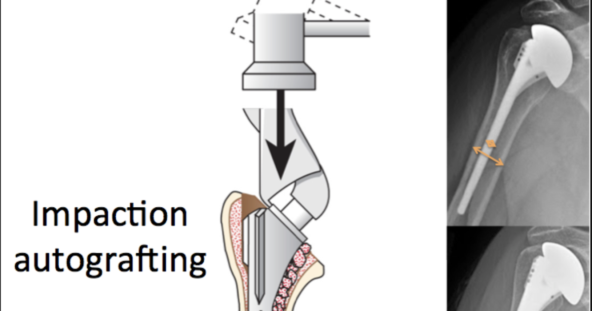 UW Shoulder and Elbow Academy: Revision to reverse total shoulders