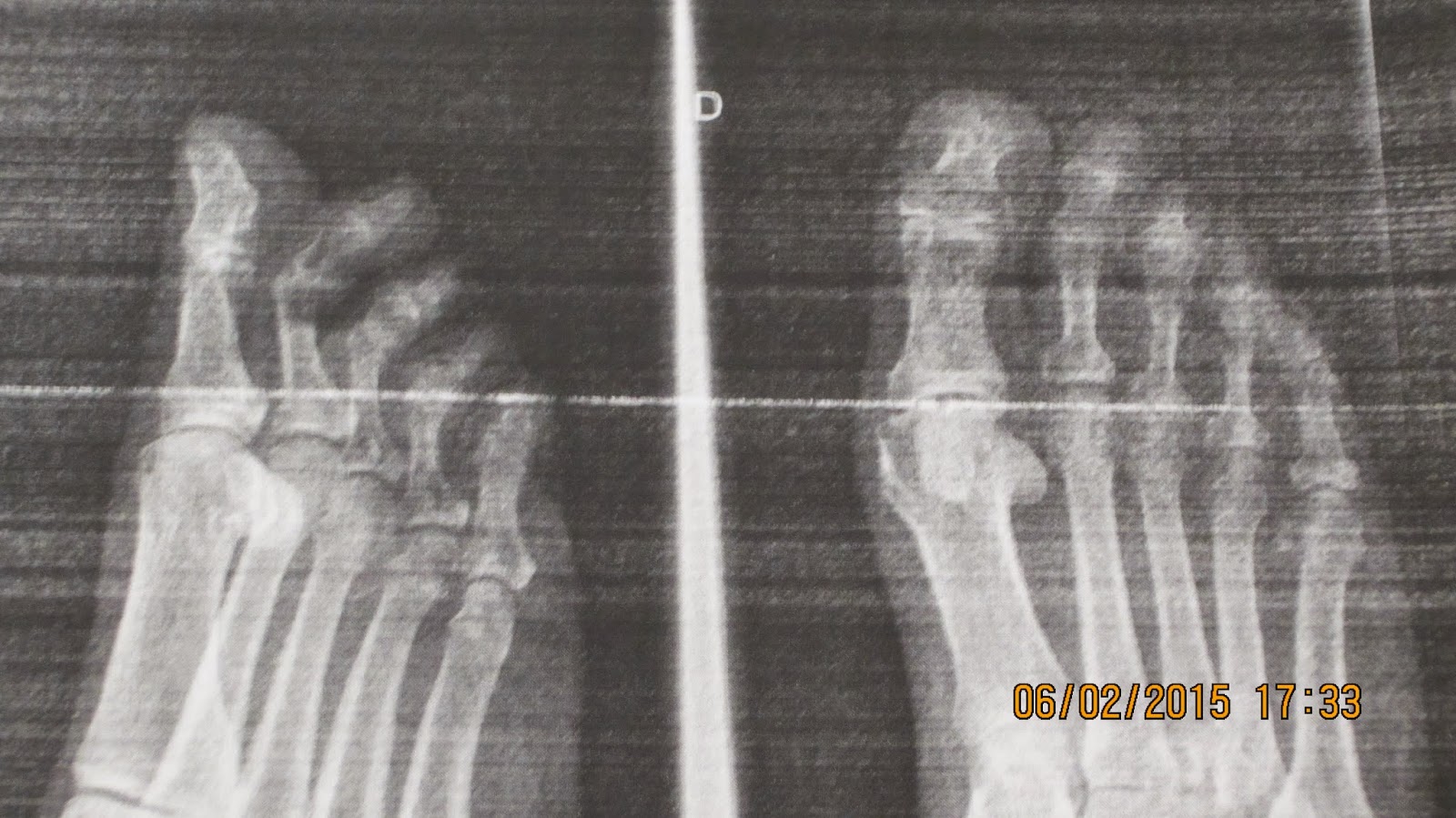 Body Art Siruela: bodyartsiruela.blogspot.com.es Eliminacion de callo ...