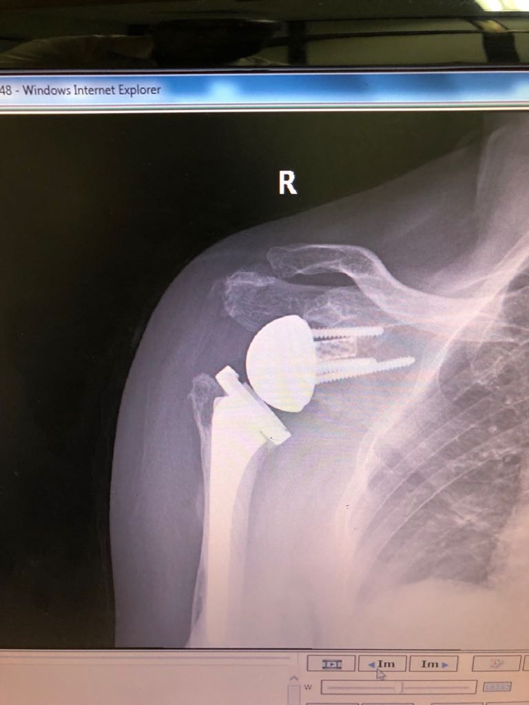 Joint Preservation and Replacement : painful dislocated rt shoulder in ...