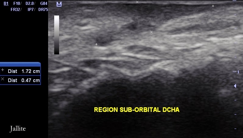 Abscesos Multiples en Cara