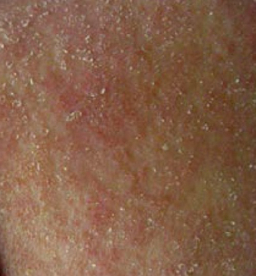 Penyakit Kulit Dermatitis Seboroik, Gejala, Penyebab & Cara Mengatasi