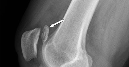 Laterale Collumfractuur