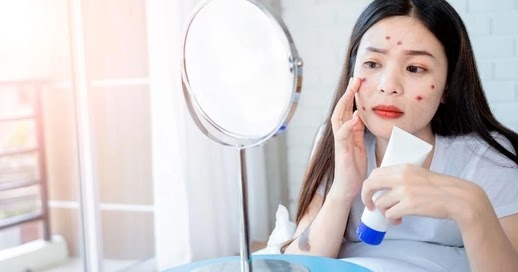 Mengenal Acne-Prone Skin dan Tips untuk Merawatnya