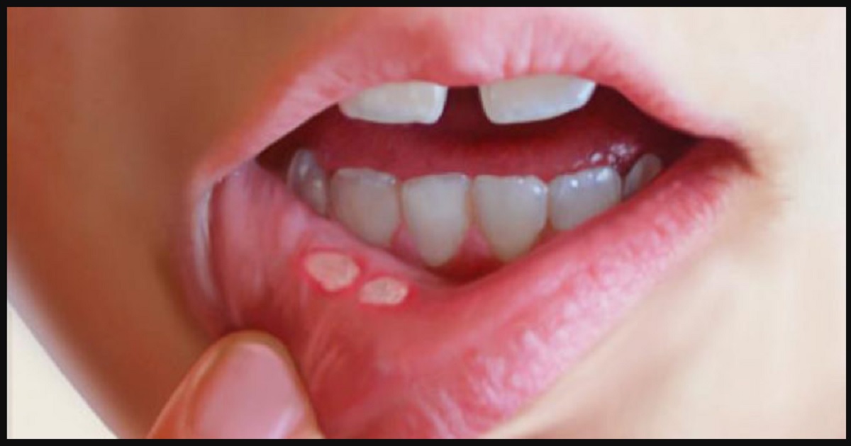 Do You Have These White Spots Inside Your Mouth Tongue Lips Or Throat do-you-have-these-white-spots-inside-your-mouth-tongue-lips-or-throat