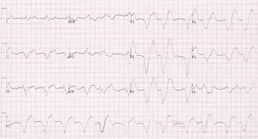 Pea pulseless electrical activity ekg - beernibht