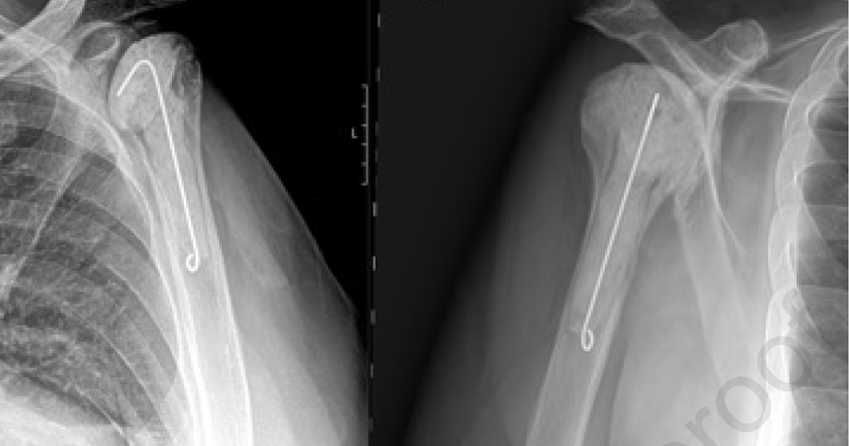 UW Shoulder and Elbow Academy: Polymethylmethacrylate spacers for ...