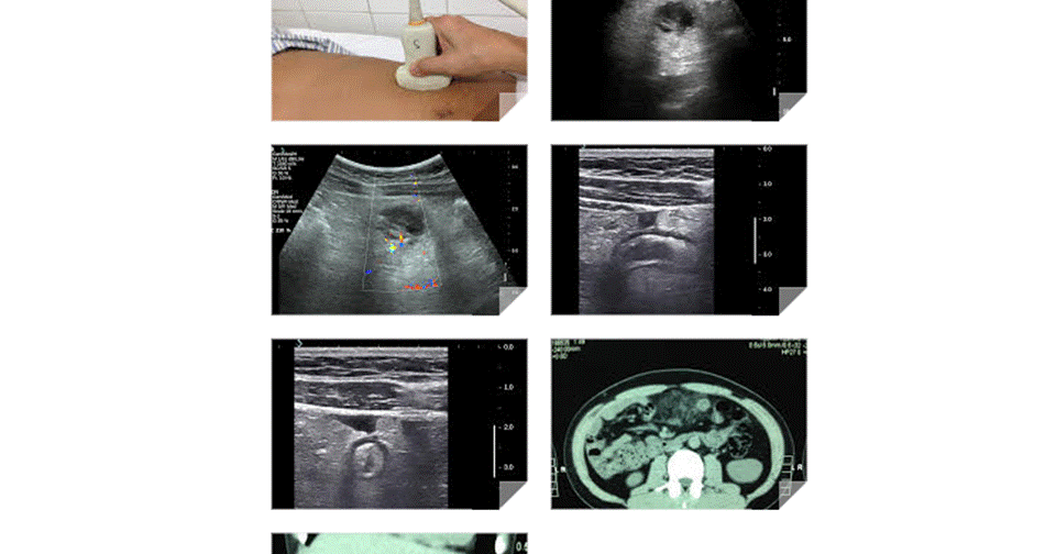 VIETNAMESE MEDIC ULTRASOUND: CASE 389: ECTOPIC APPENDICITIS, Dr PHAN ...