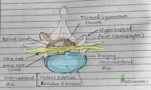 Medicowesome: Cauda equina syndrome