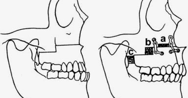 Cleft Lift and Palate: Vertical Maxillary Growth After 2 Different Surgical Protocols in ...