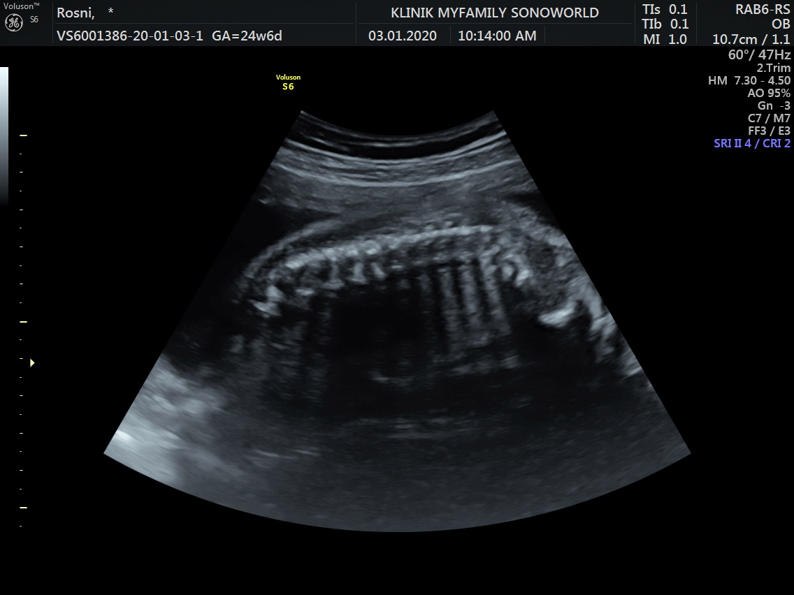 Pregnancy Journey - Buat Detail Scan di Klinik Myfamily by Mysonoworld ...