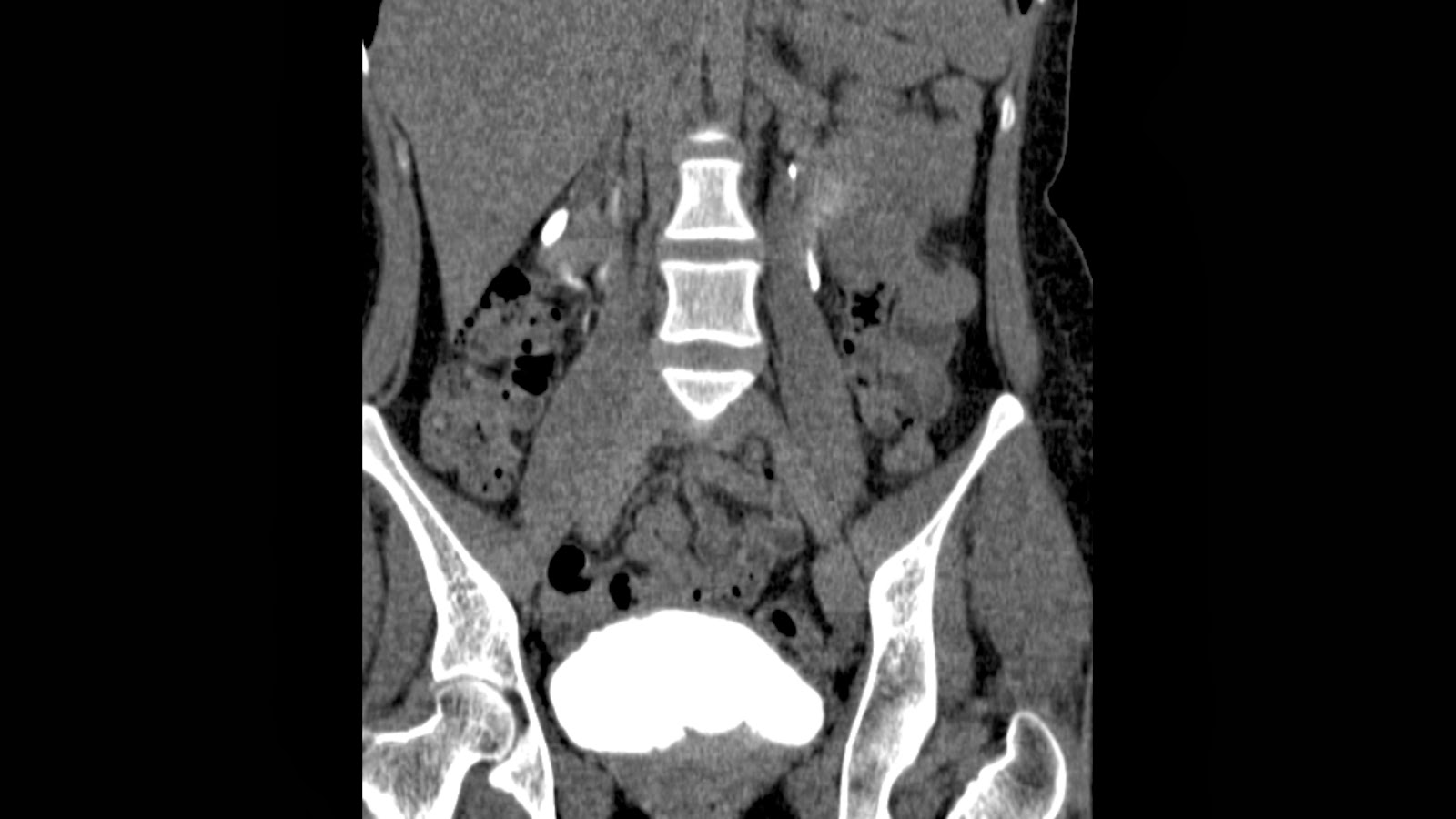 Ultimate Radiology : Renal Duplex Systems