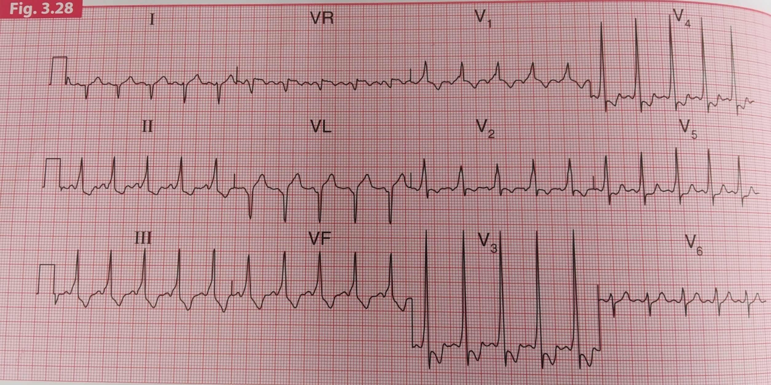 EASY WAY TO REMEMBER: WPW SYNDROME