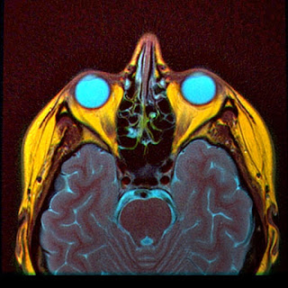 Nevit's blog: Color MRI of Orbita